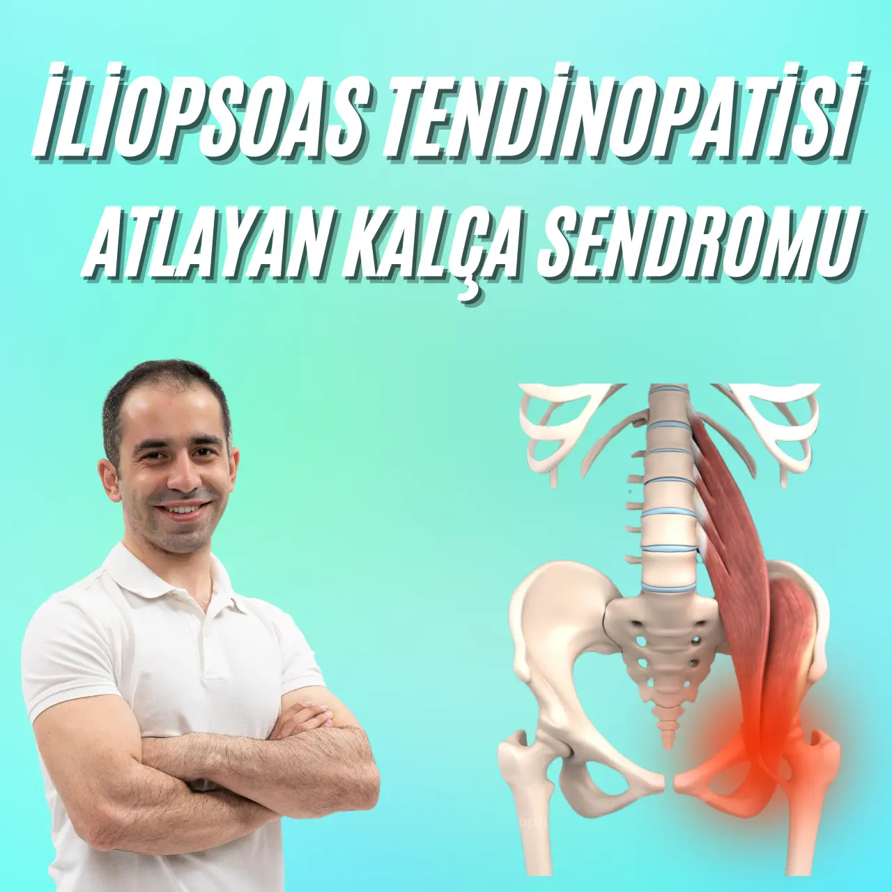 İliopsoas Tendinopatisi (Tendinit) - Snapping Hip - M Terapi
